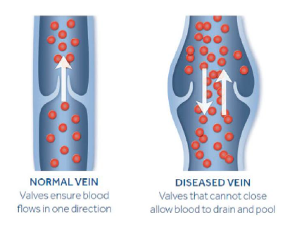 Venous Disease / Vein Clinic | Arizona Heart & Vascular Clinic